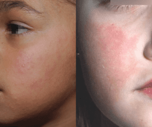 But why is it called 'Fifth disease'? Facts on 'slapped cheek' (Fifth ...